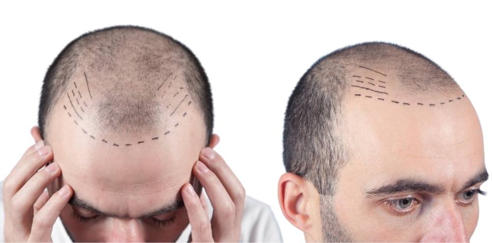 Hairline Design: How Hair Transplants are Revolutionizing the Way We ...